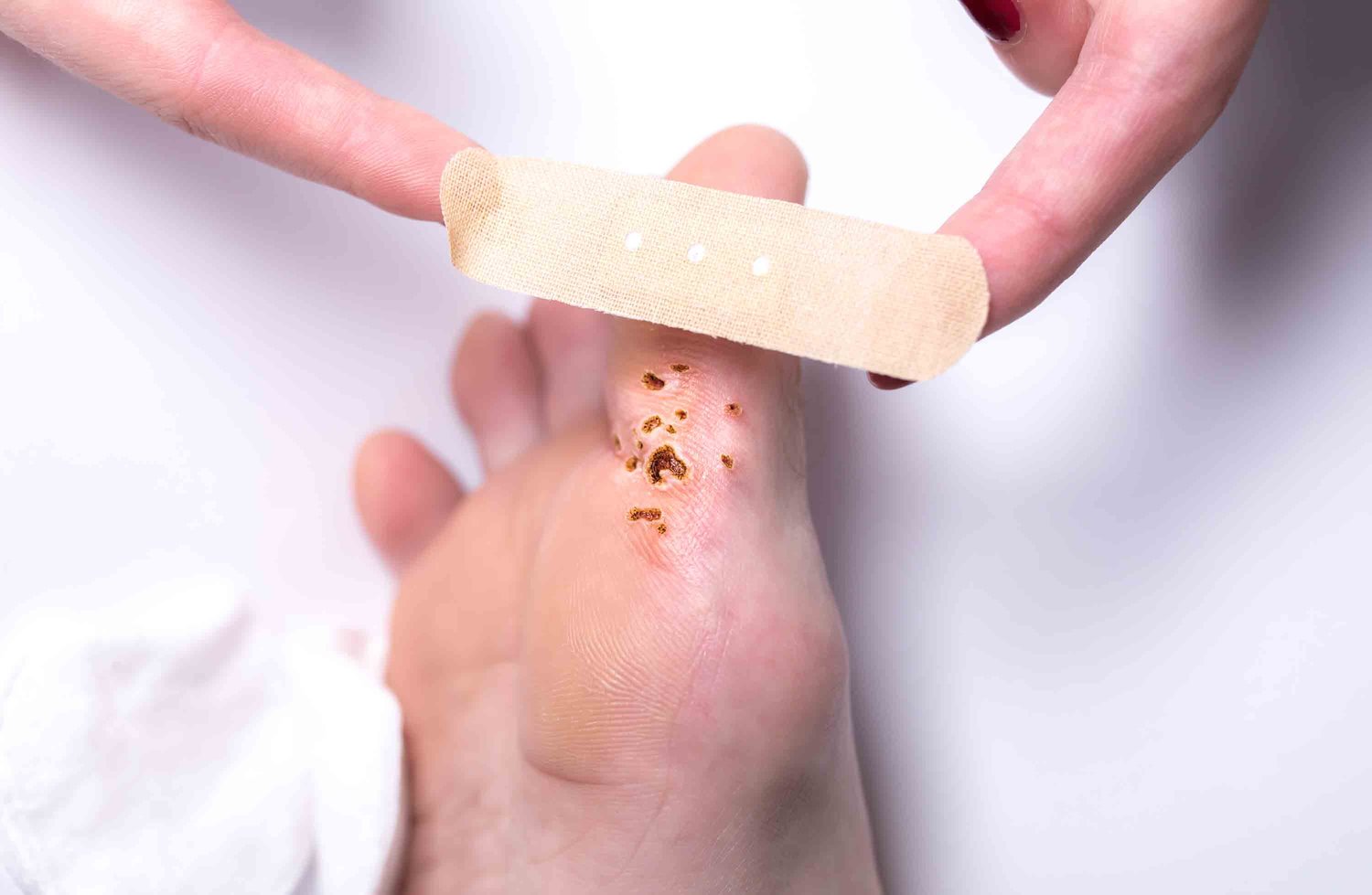 Comment reconnaître une verrue