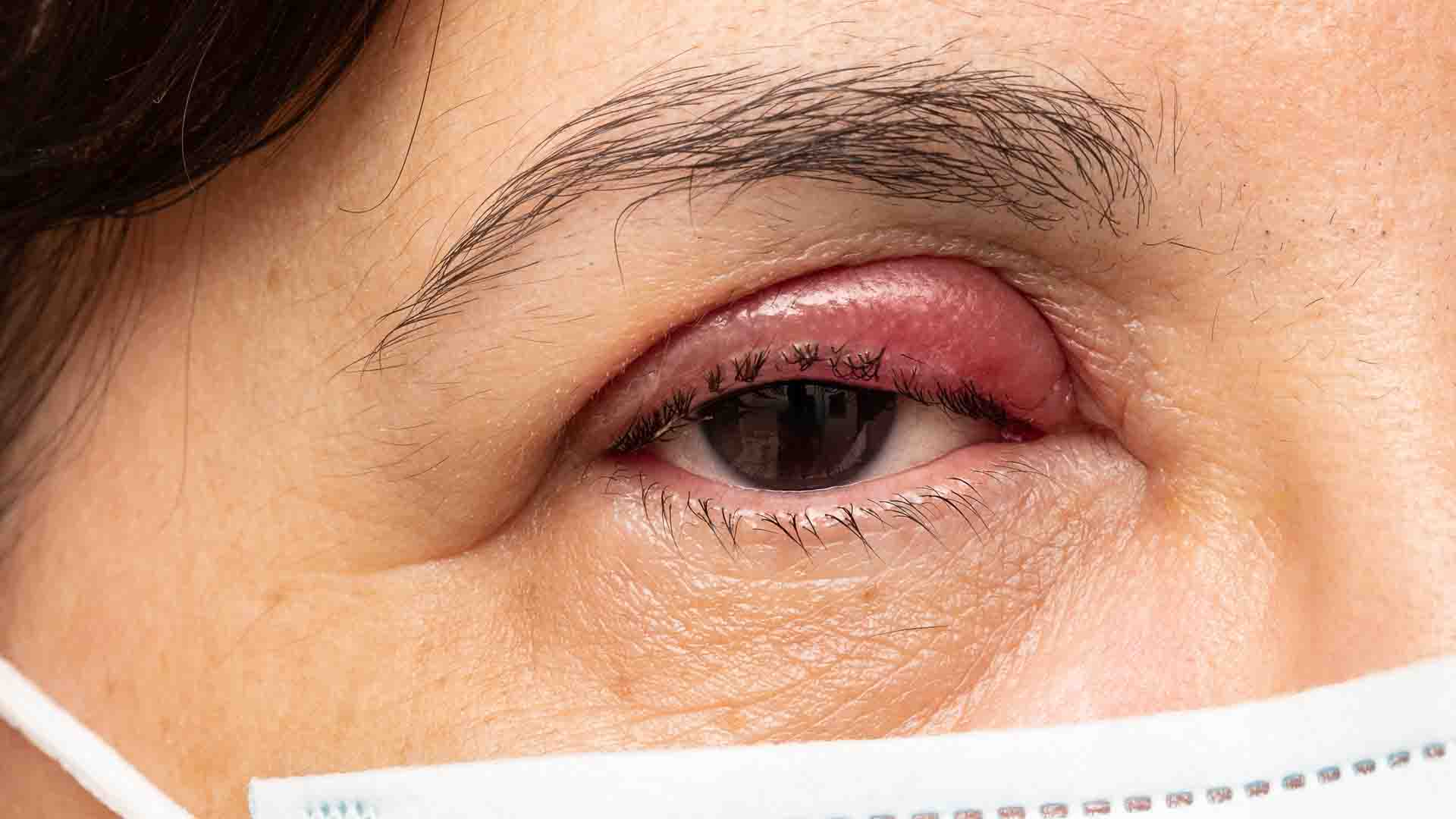 Staphylocoque doré : qu'est-ce que c'est