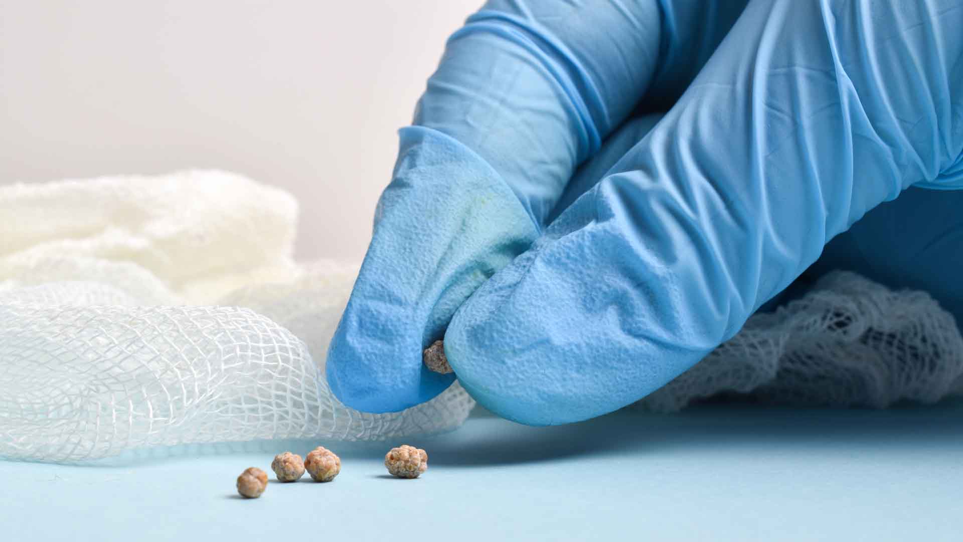 Calculs de la vésicule biliaire : symptômes et traitements