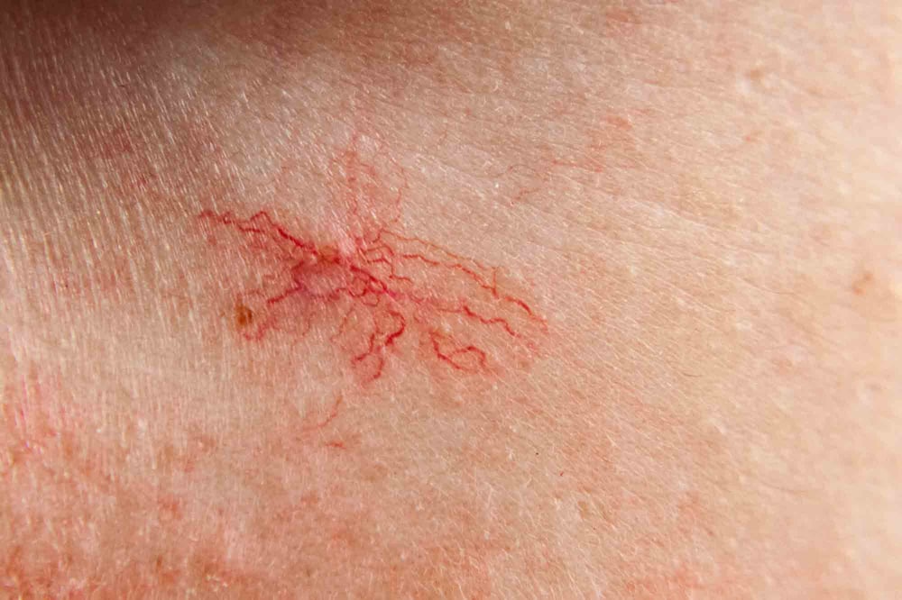 Couperose : définition, types de rosacée, causes et traitement