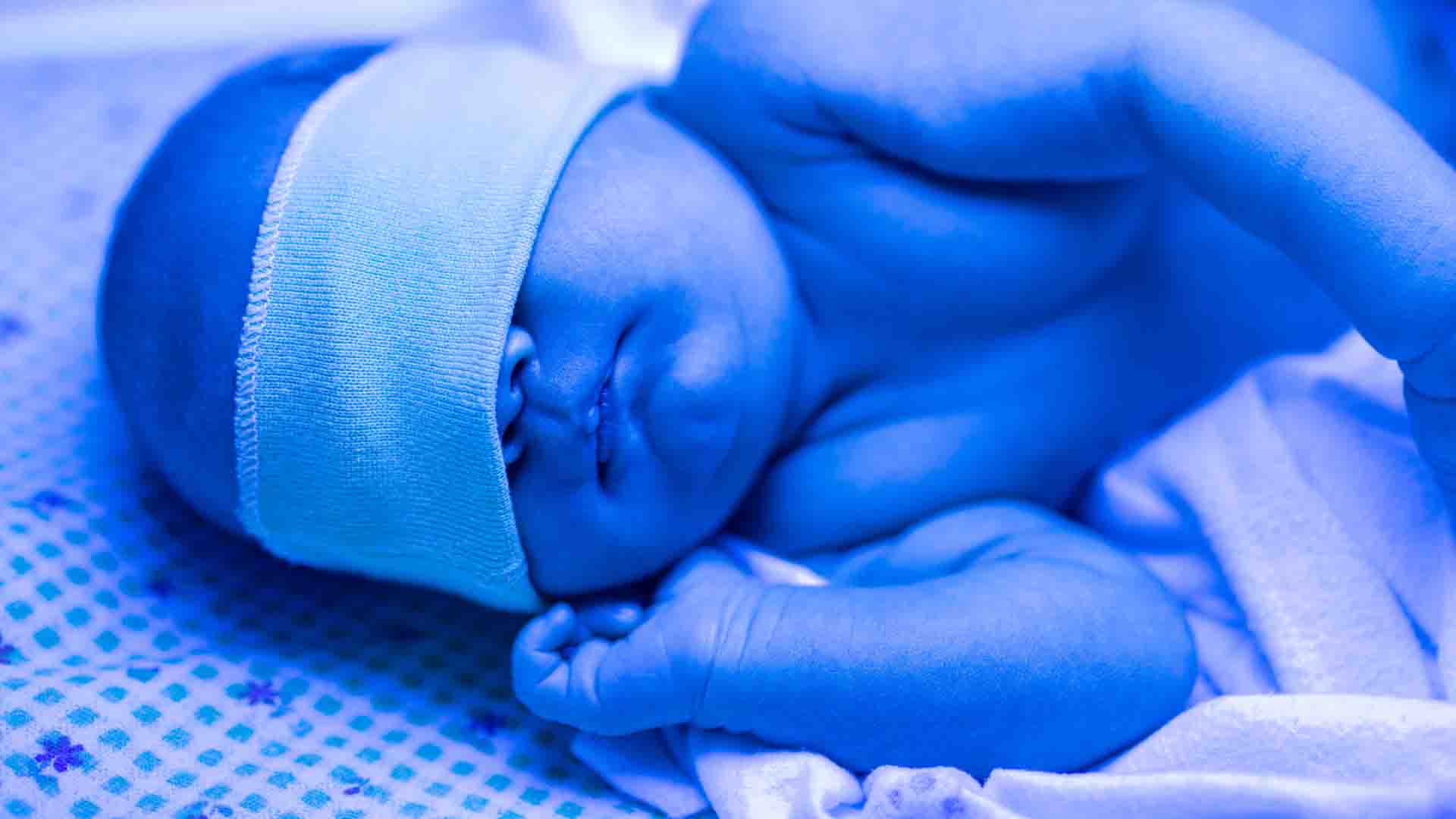 Les causes de l'ictère chez l'adulte et le nouveau-né