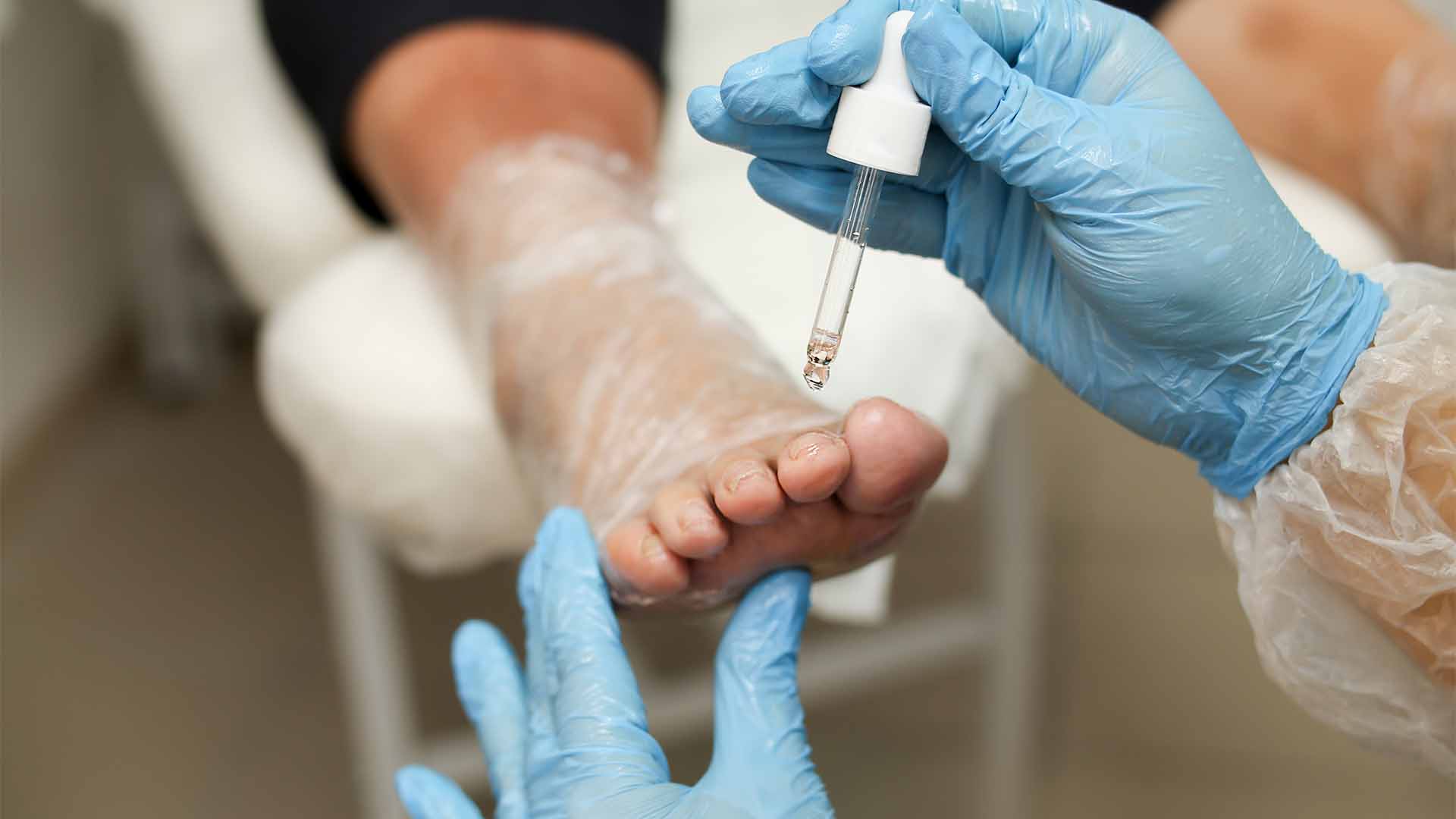 Comment reconnaître une mycose de l’ongle de pied