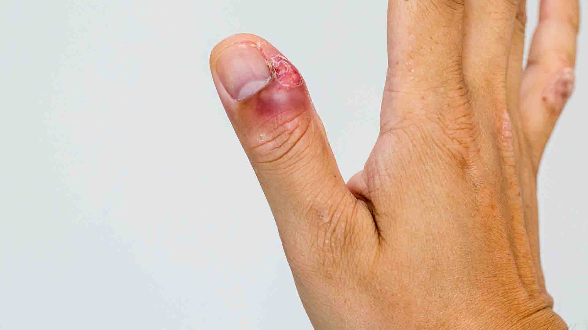Quelles sont les causes d'un panaris au doigt