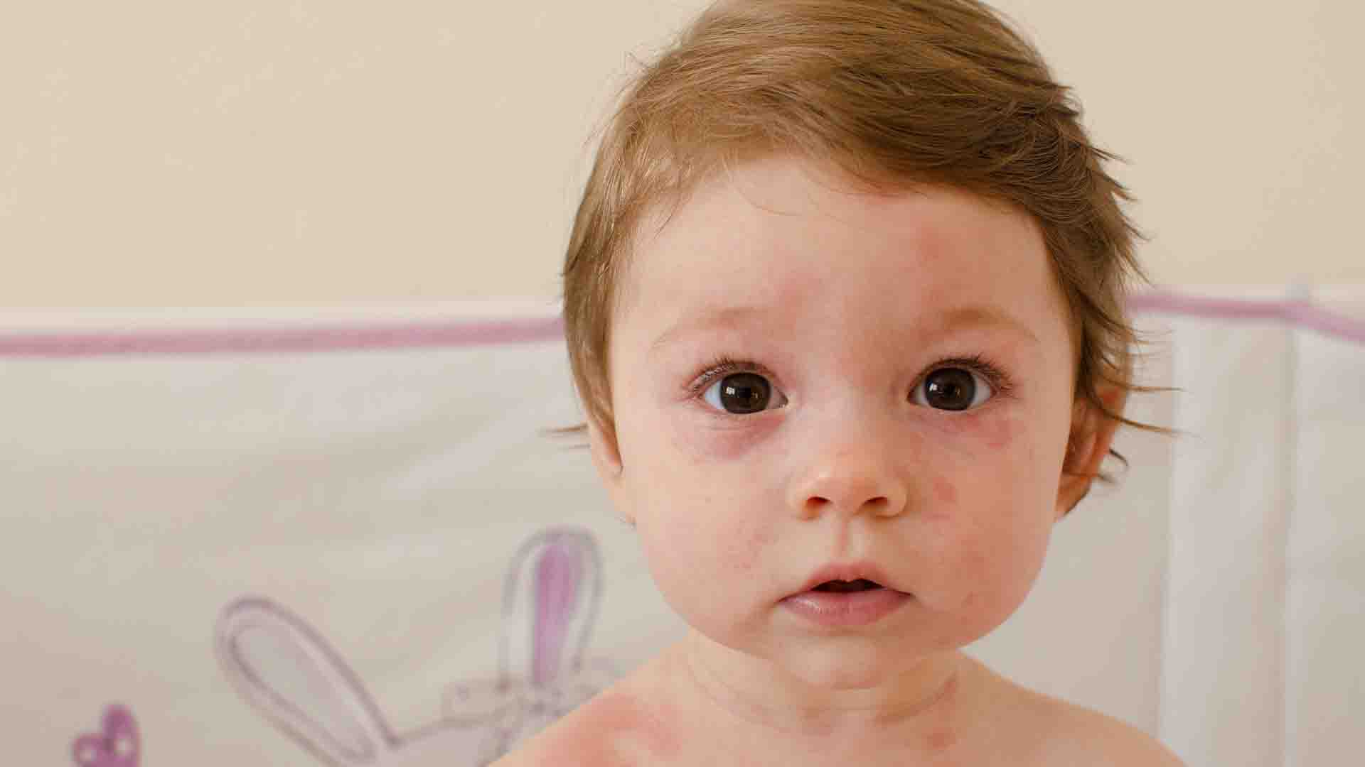 Rubéole : définition, symptômes, traitement et prévention