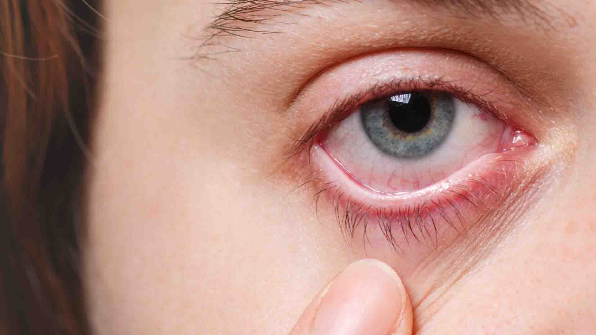 Comment soigner une uvéite